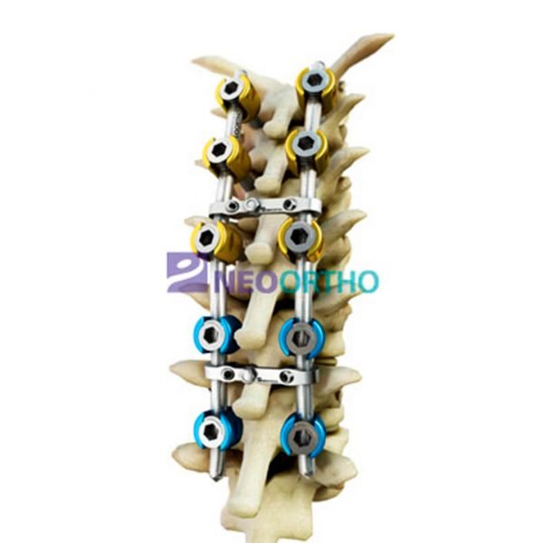 Neospine G2 – Sistema de instrumentacion de columna | Orlosh
